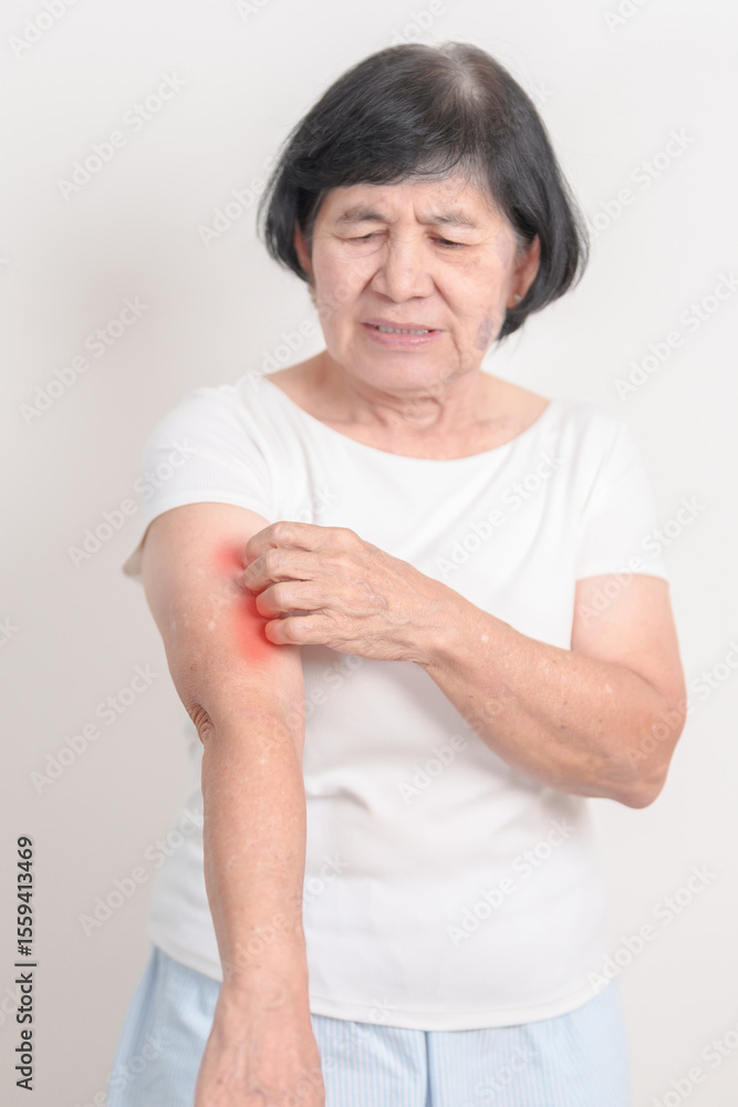 Foto de Stock Elderly woman itching arm and body scratching for Skin ...