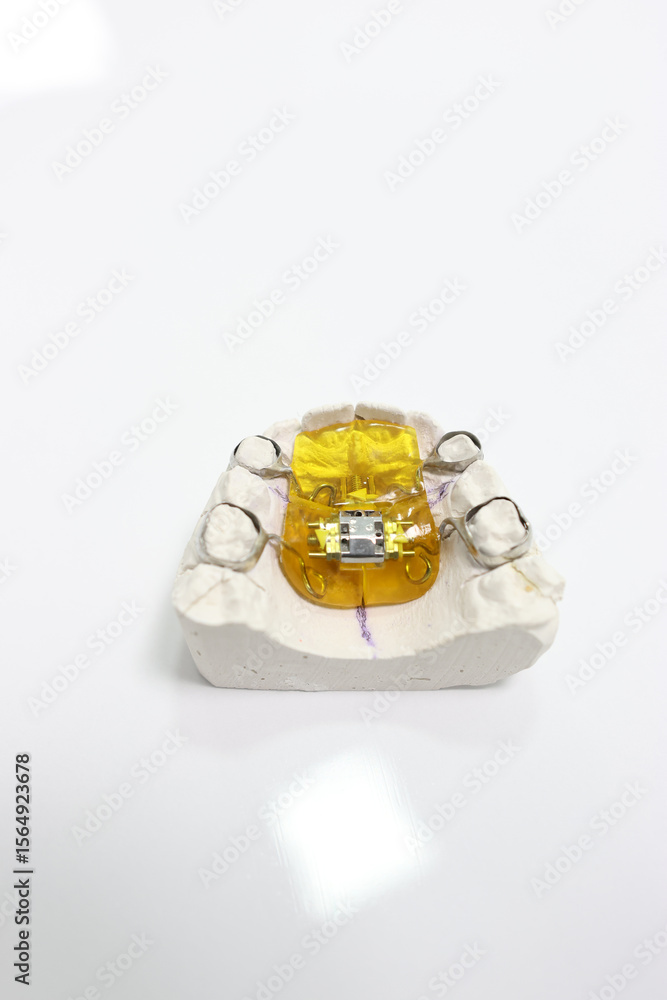 Mandibular teeth cast. Obtaining a cast of the dental arch for the ...