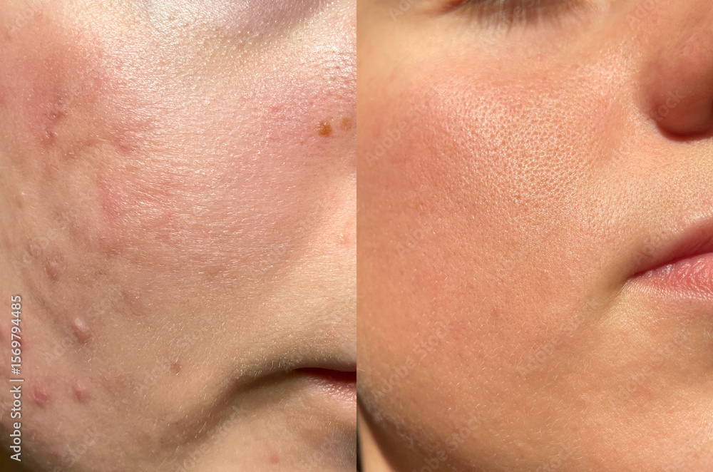 Close-up showing severe acne, pores, and smoother healthy skin after ...