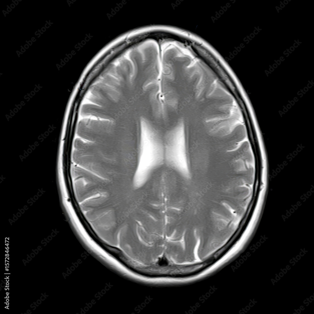 Стоковое фото «Axial T2-weighted MRI of a 40-year-old showing normal ...