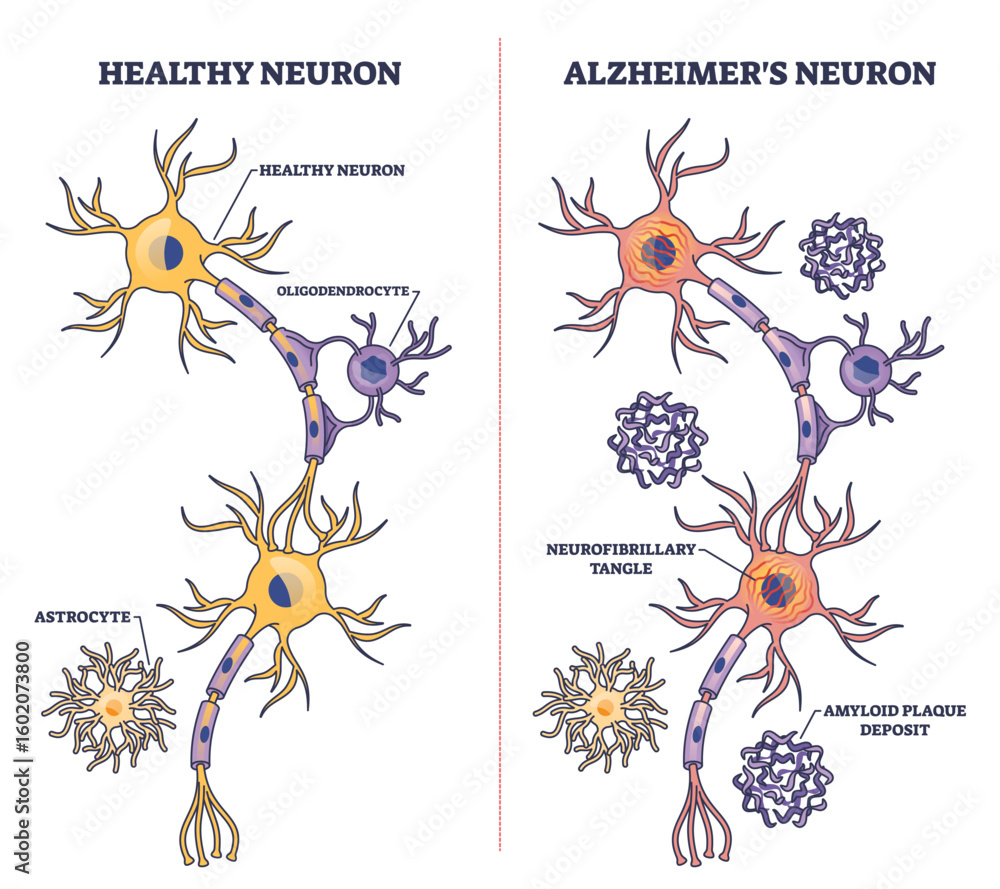 Alzheimers neuron diagram shows comparison of healthy and diseased ...