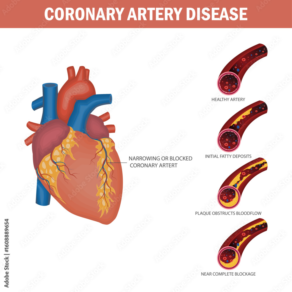 Medical illustration of coronary artery disease progression showing ...