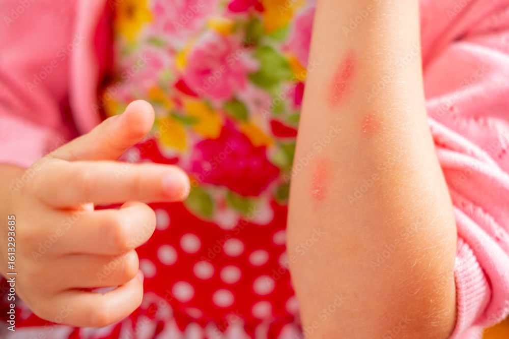 Child's arm with rash, skin irritation, scratching, Young girl's itchy ...