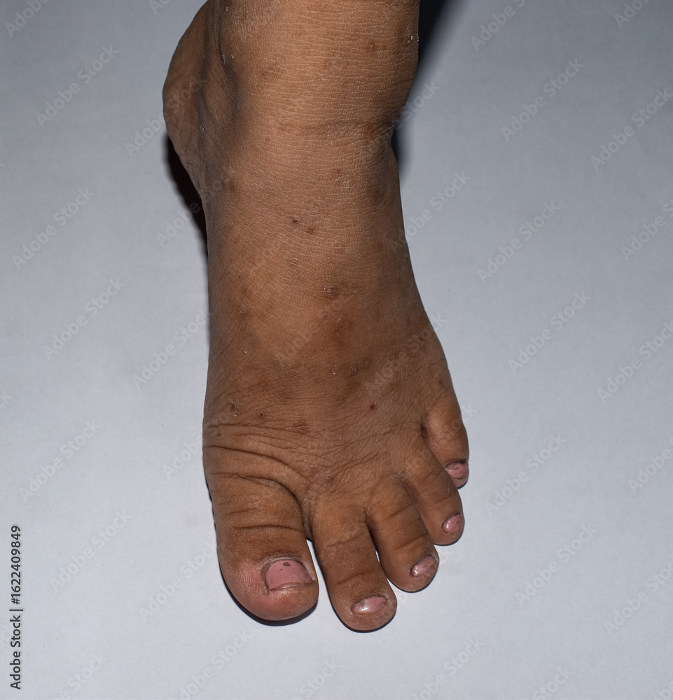Scabies Infestation on Human Foot with Visible Skin Lesions and ...