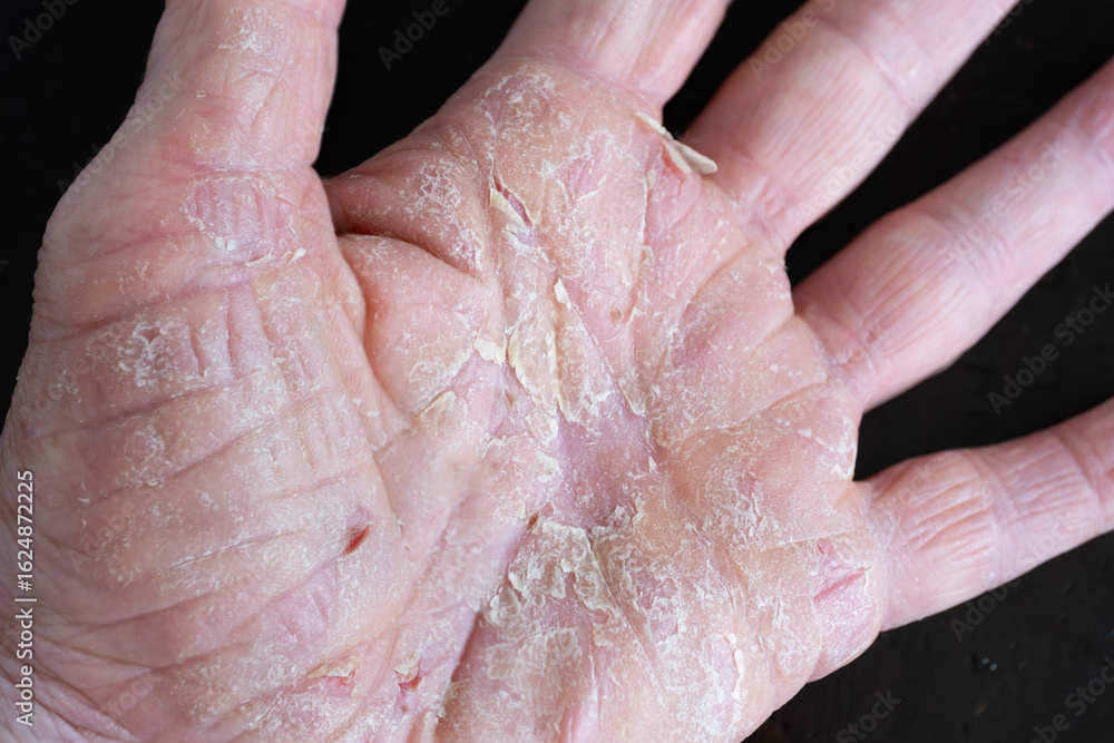 Chronic dermatitis on the hands. Hand eczema, also known as atopic dermatitis, with redness ...