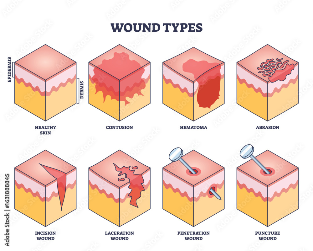 contusion wound example