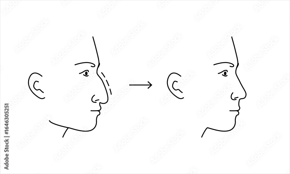 Vetor Outline vector illustration showing rhinoplasty of noce hump of a ...