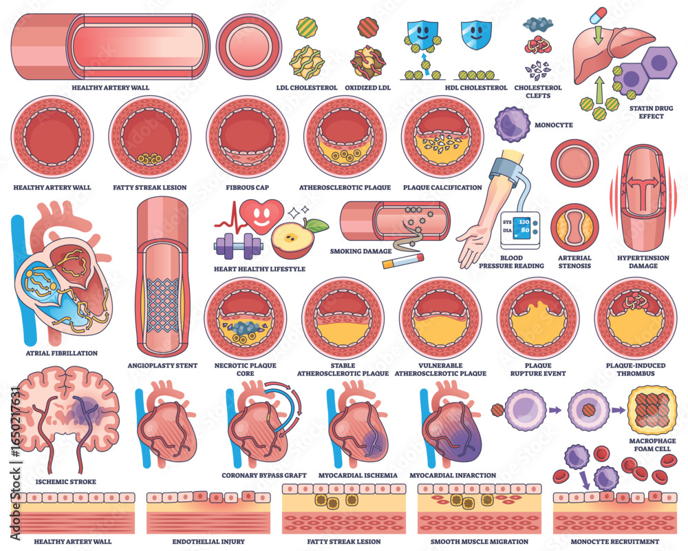 Atherosclerosis and cardiovascular disease are illustrated with artery ...