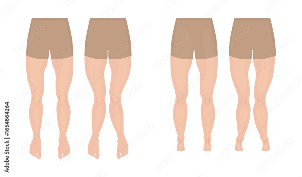 Genu valgum, genu varum and normal legs, front and back view comparison ...
