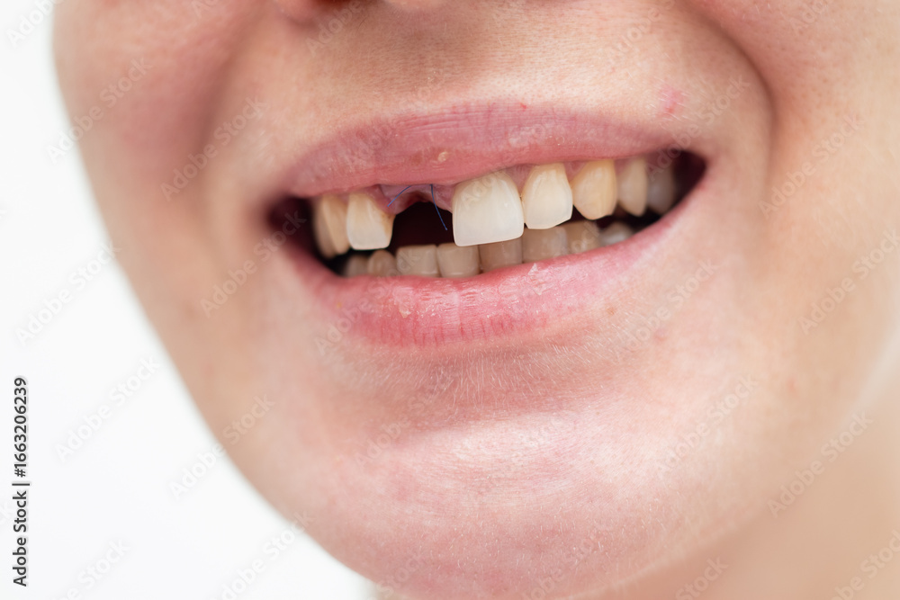 Young woman smiling without a front tooth. Implant placement surgery ...