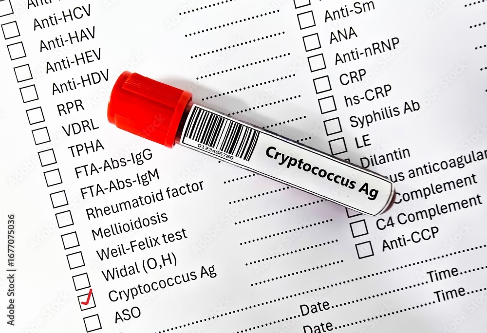 Blood sample tube and paper order request cryptococcus Ag test analysis ...