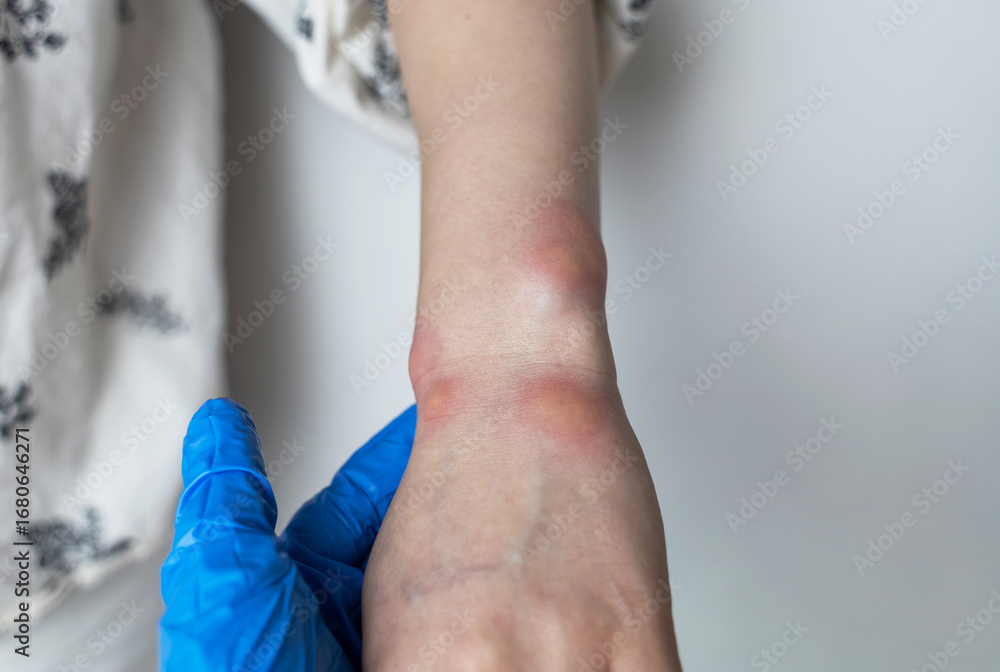 Fotografie Close up of a swollen wrist with visible redness ...