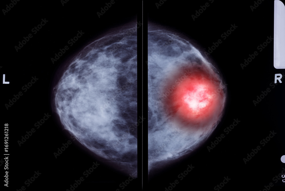 X-ray mammography for breast cancer, checking breasts. Breast scan, cc ...