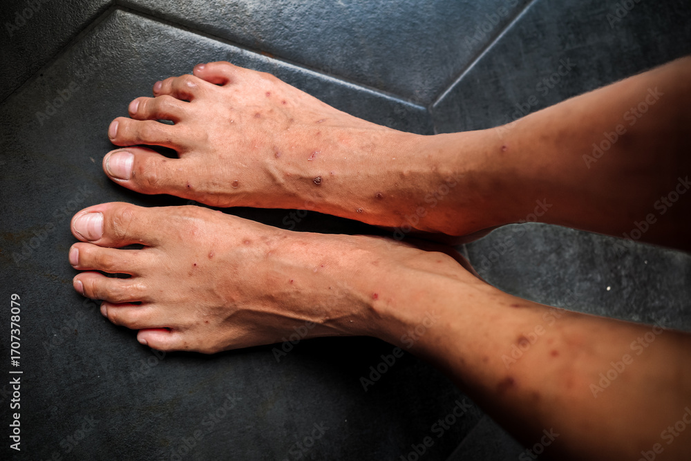 Itchy skin rash and red spots all over a girl's legs and feet. Skin ...