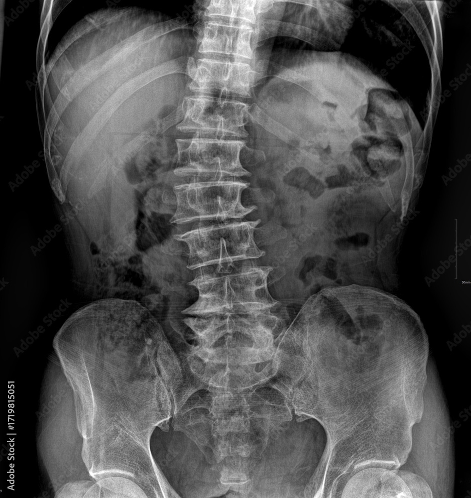 This image shows an X-ray of the abdomen, also known as an abdominal ...