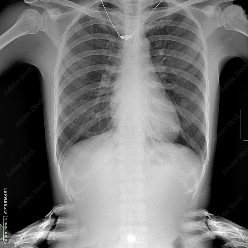 This image shows a chest X-ray, a common imaging test used to create ...
