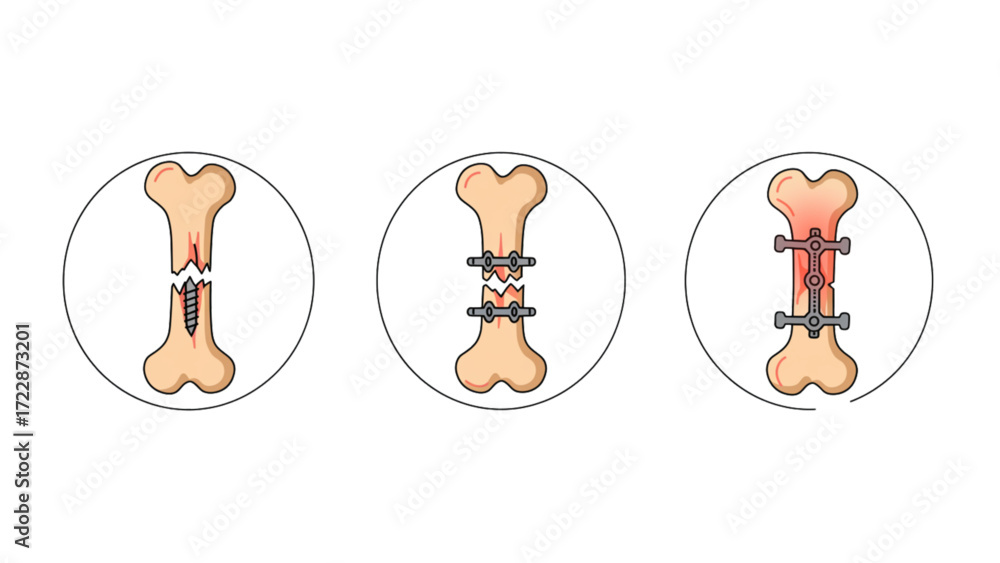 Advanced Bone Fracture Healing Process with Surgical Fixation and ...