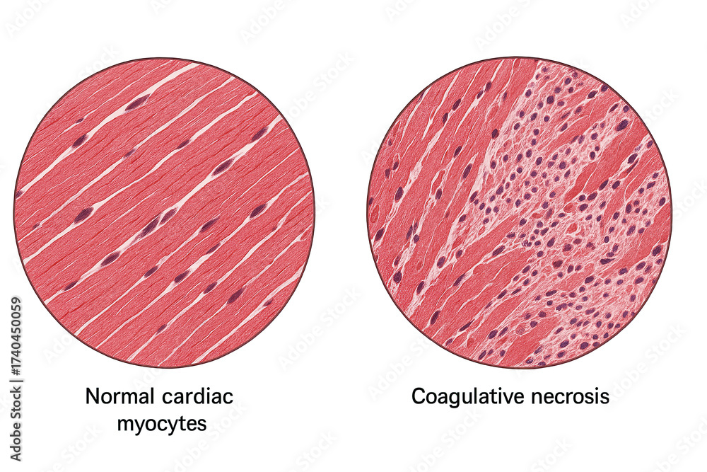 Ilustración de Stock Microscopic comparison of normal cardiac myocytes ...