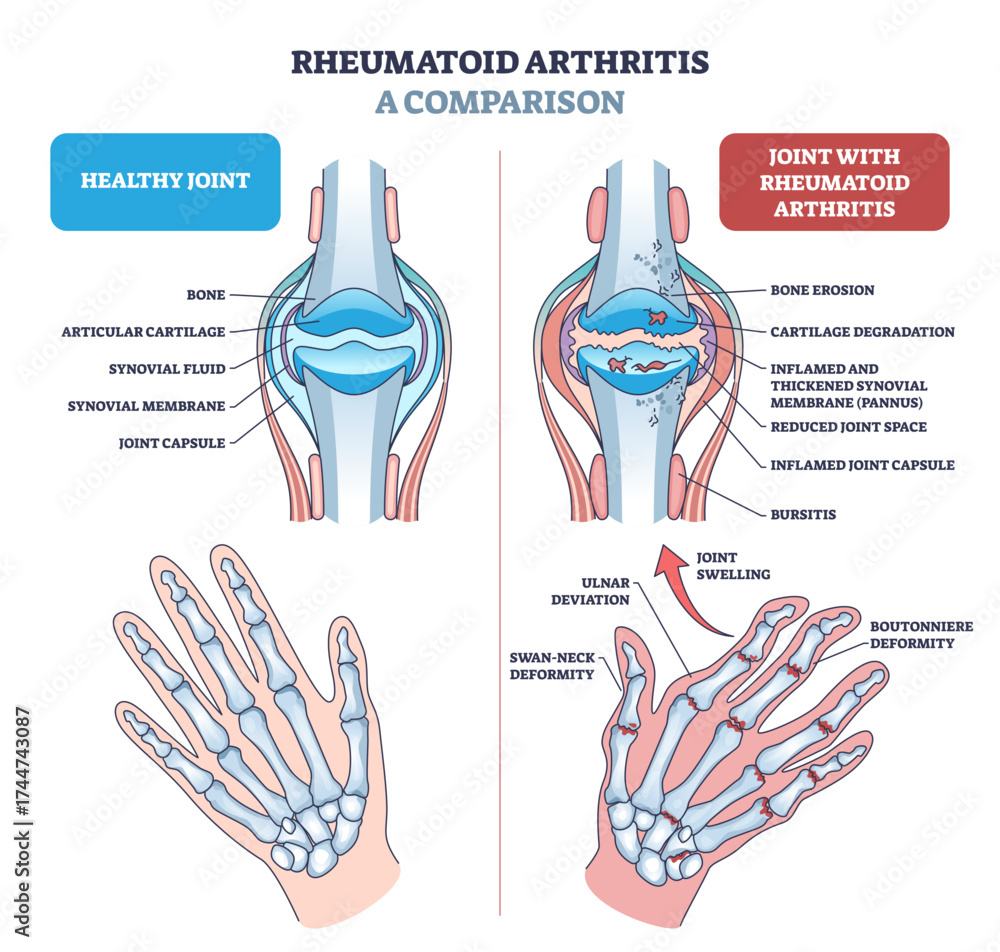 Rheumatoid arthritis diagram shows a comparison between healthy and ...