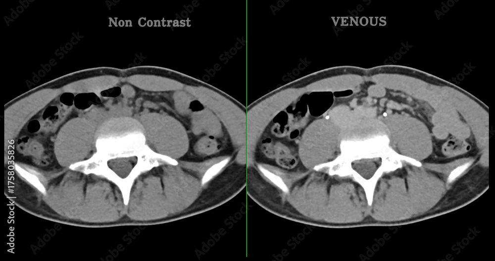 High-resolution CT scan Lower abdomen showing a normal lower abdomen ...