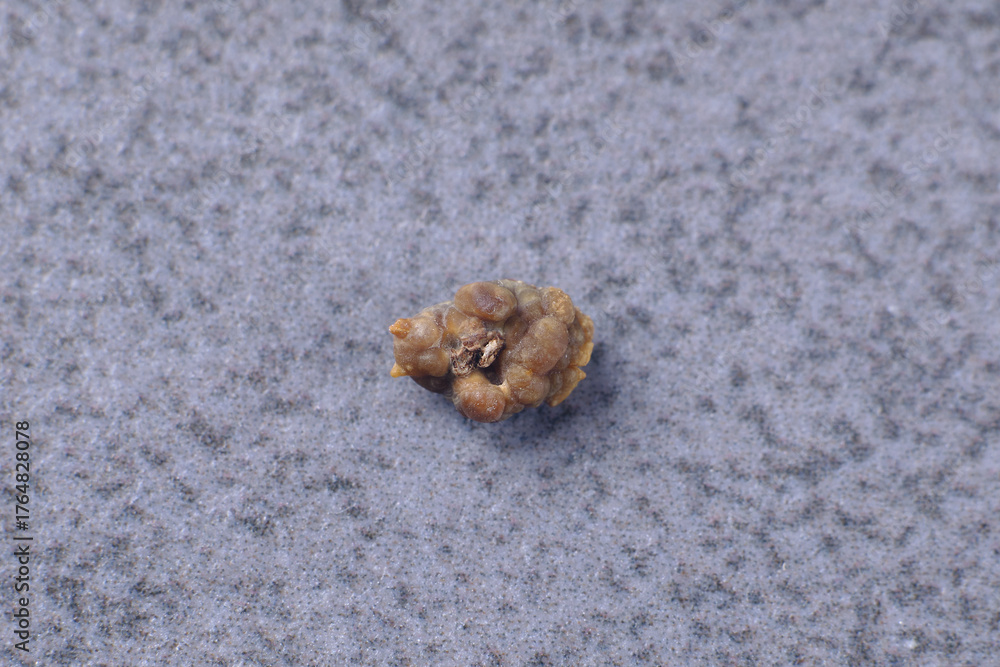 Oxalate stone. Medicine, urology. Macro photo of a kidney stone. Renal ...