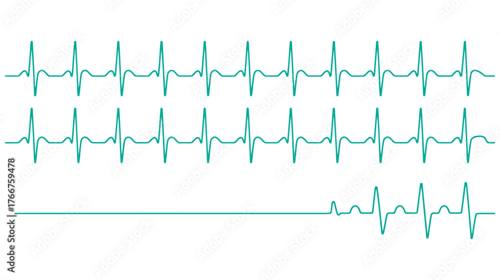 Heartbeat EKG Monitor Waveform Medical Line Illustration Stock Vector ...