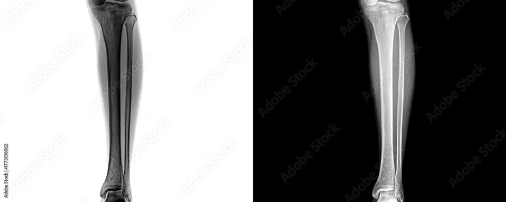 Stock-Illustration „Leg Anterior View X-Ray Showing Tibia and Fibula ...