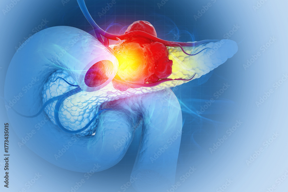 Illustration Stock Pancreatic cancer is cancer that forms in the cells ...