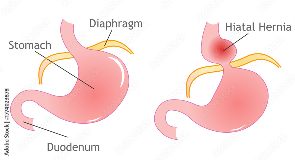 Hiatal hernias and acid reflux. Condition where a small part of the ...