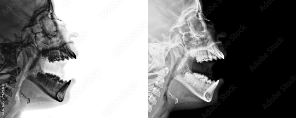 Diagnostic X-Ray of Nasopharynx in Lateral View Depicting Enlarged ...