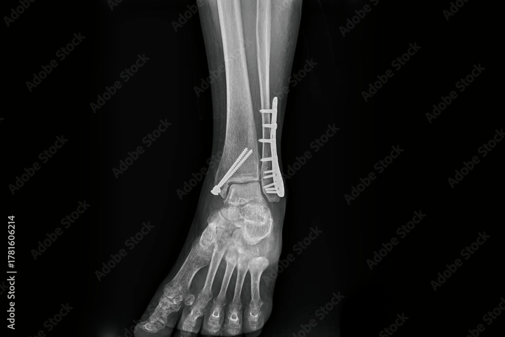 Ankle X-ray radiograph showing fracture with surgical plate and screws ...