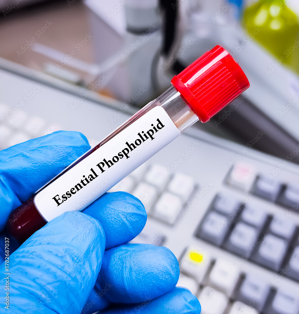 Blood sample tube for Anti Cardiolipin Antibodies(ACA) test, diagnosis ...