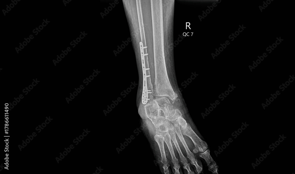 Stock-Foto „Lateral ankle X-ray showing distal tibia fracture with ...