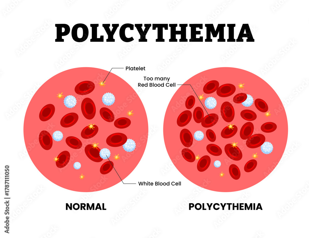 Polycythemia vs normal blood specimen blood composition comparison ...