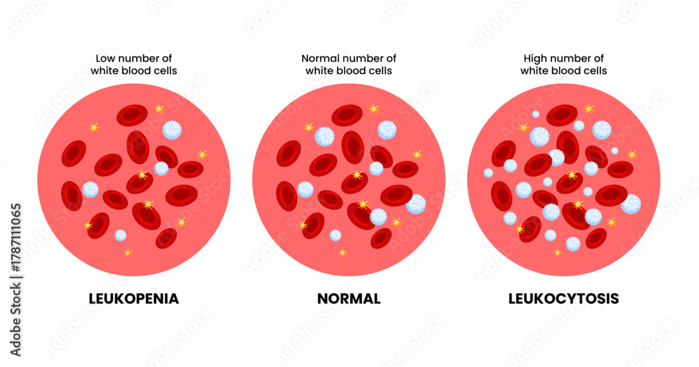 Leukopenia, normal blood vs Leukocytosis specimen blood composition ...