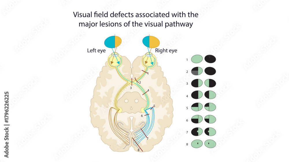 Visual field defects isual field defects refer to loss of vision in ...