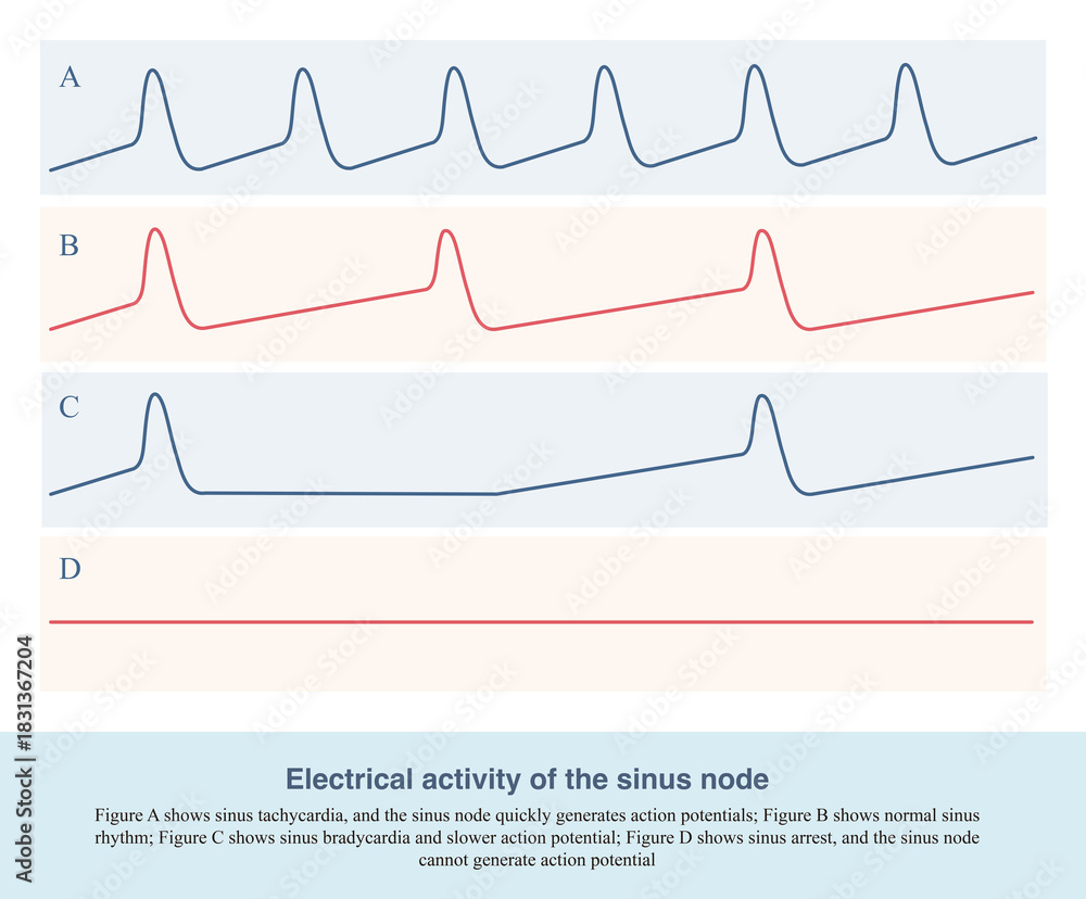 Illustration Stock The mode of action potential produced by sinoatrial ...