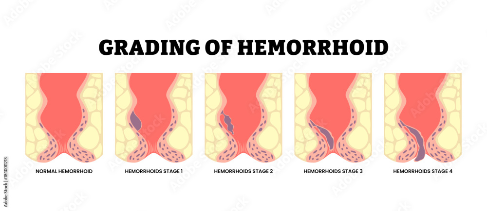 Grading of hemorrhoid stages. Gradual proliferation of hemorrhoidal ...