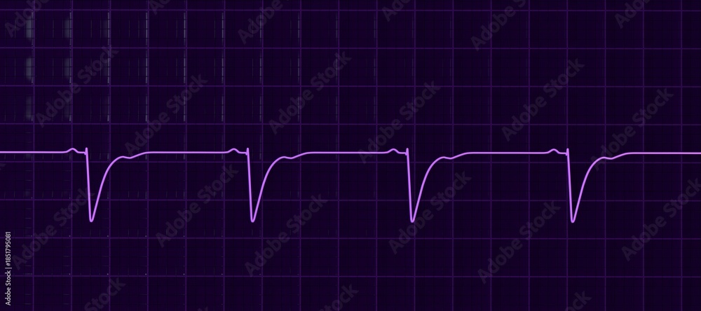 Left ventricular hypertrophy, 3D illustration showing ECG leads V1-V2 ...