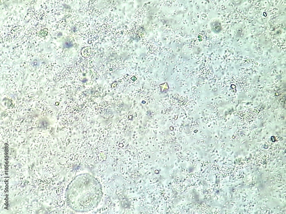 Microscopic view of urinary sediment showing calcium oxalate crystals ...