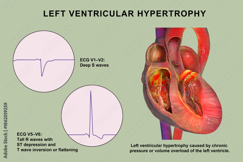 Left ventricular hypertrophy, 3D illustration showing thickened left ...