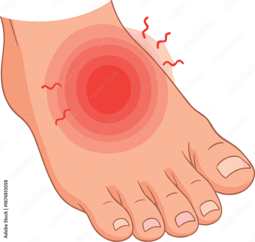 Human foot medical diagram showing acute ankle pain with red concentric ...