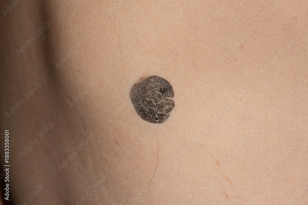 Seborrheic keratosis on human skin, showing a common benign skin growth ...