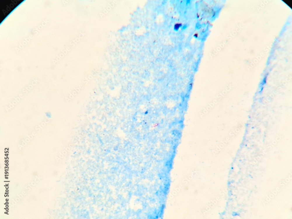 Microscopic view of Mycobacterium tuberculosis in a sputum smear using ...