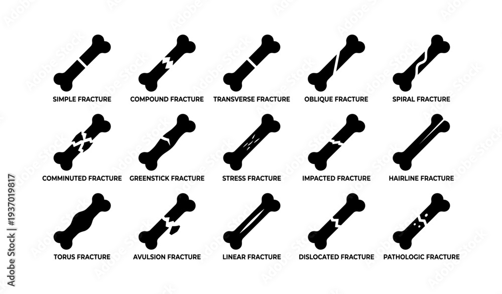 Types of bone fractures: simple, compound, transverse, oblique, spiral ...