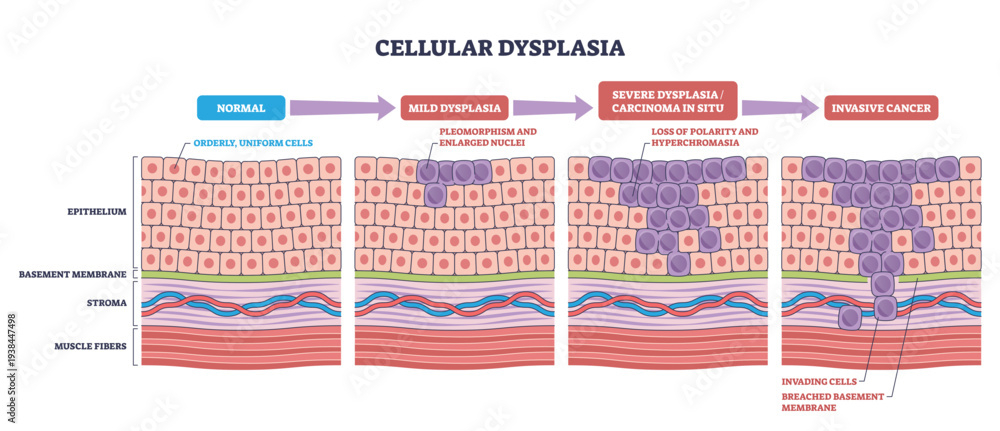 Cellular dysplasia diagram maps stages from normal epithelium to ...