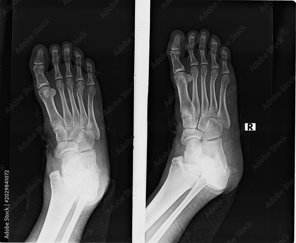 Computed Radiography of Leg and Ankle Joint Displaying Skeletal Anatomy ...
