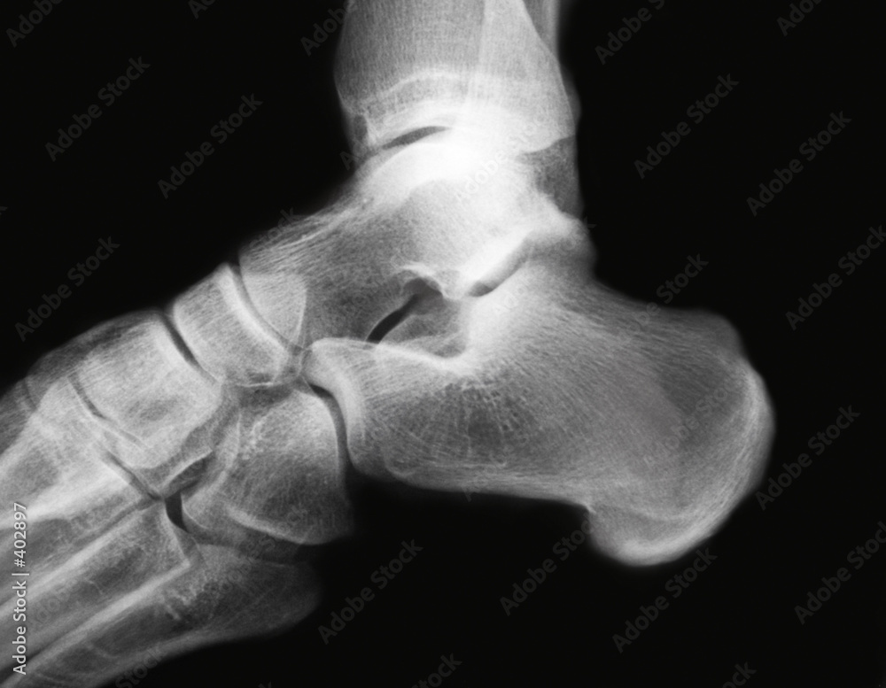 Ankle X ray Stock Photo Adobe Stock ankle-x-ray-stock-photo-adobe-stock