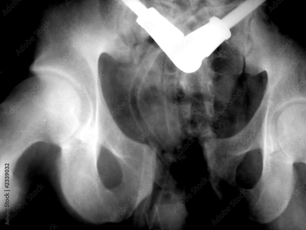 pelvis x-ray Stock Photo | Adobe Stock