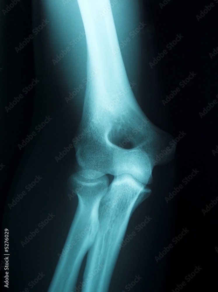 x-ray of a male arm Stock Photo | Adobe Stock